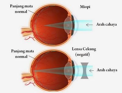 cara menyembuhkan presbiopi