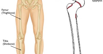 Desert Orthopaedic Center: Limb Length Discrepancy