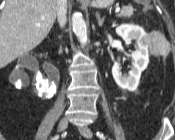 Radiology Station Malacoplaquia Una Enfermedad Rara