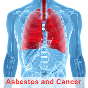 Lung Cancer Caused By Asbestos