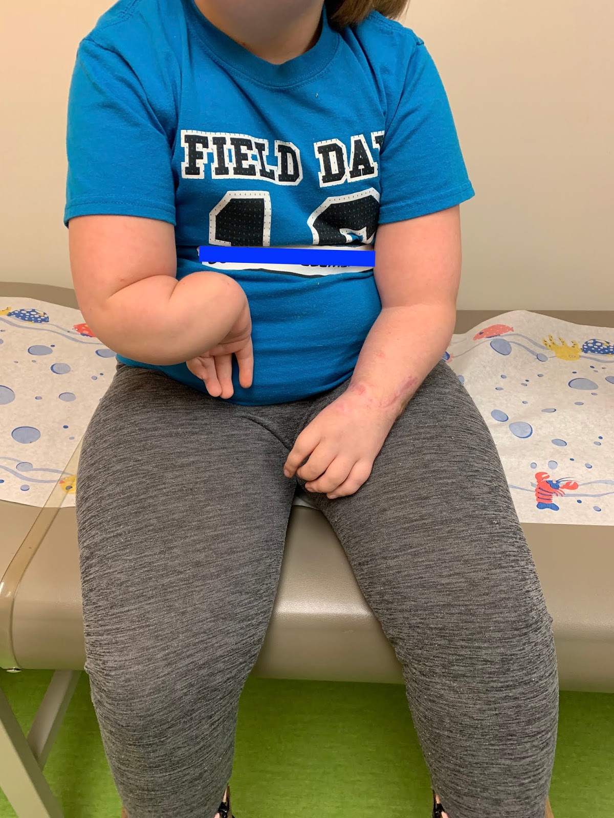 Severe Radial Deficiency, Before and After | Congenital Hand and Arm ...