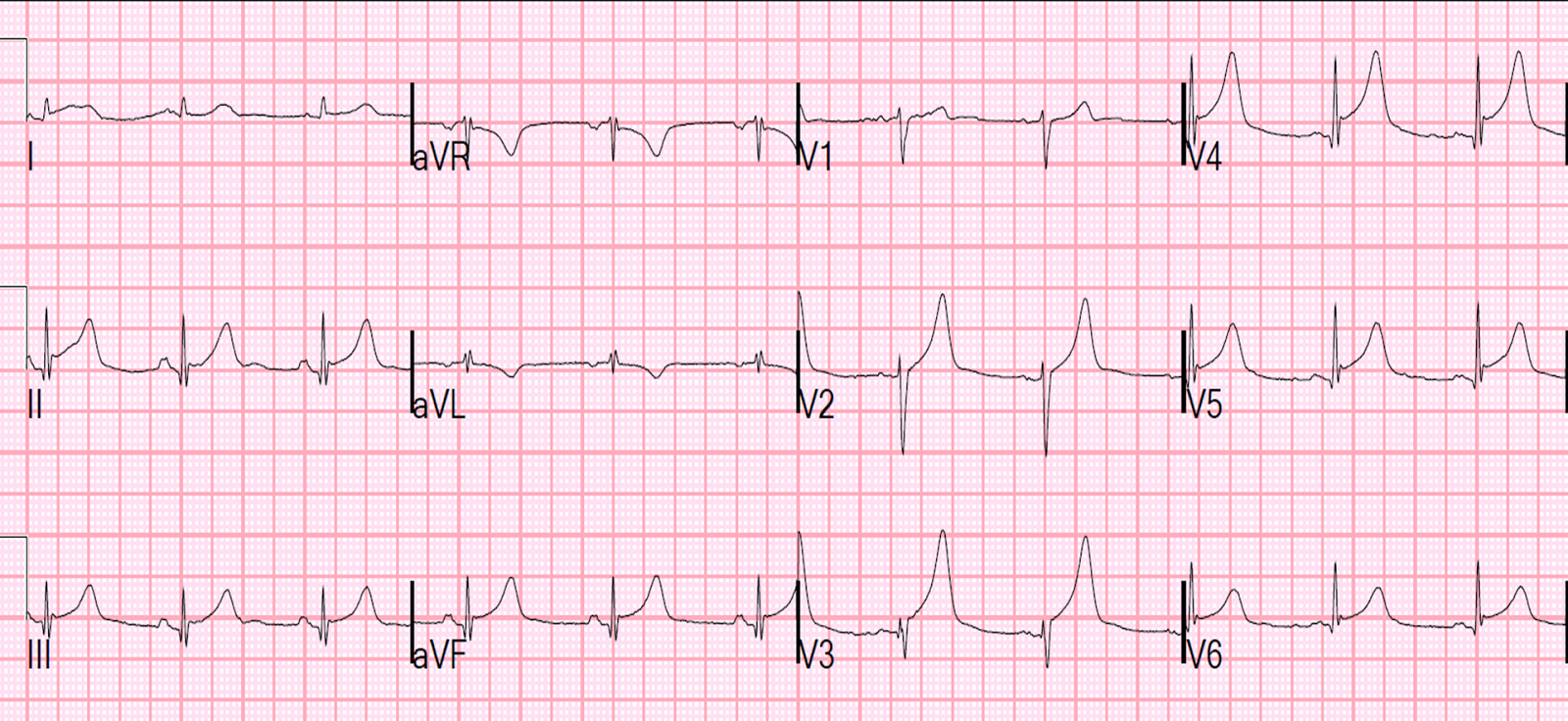 Dr. Smith's ECG Blog: August 2013