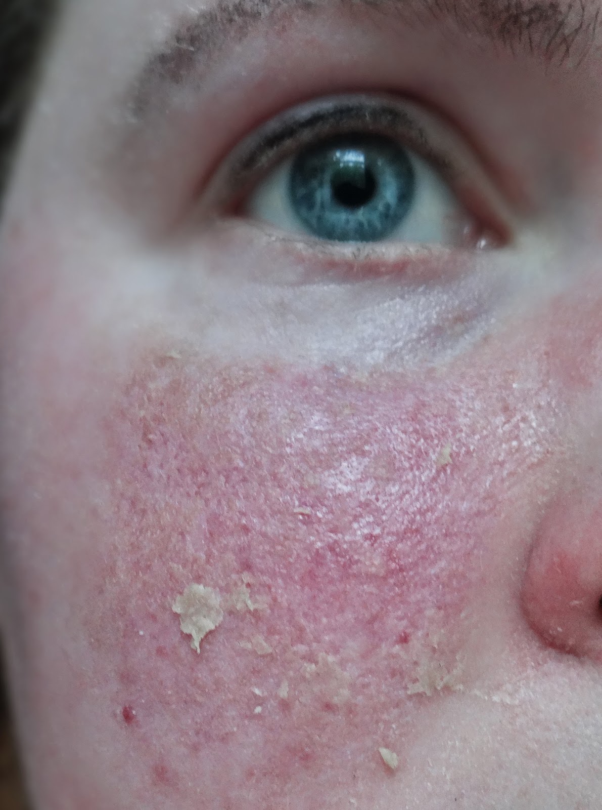 dr.Lestari Rahmah, MKT: DERMATITIS SEBOROIK