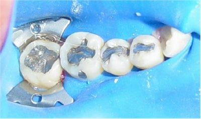 Física Dental Aplicada: La Amalgama, aleación por excelencia en la ...