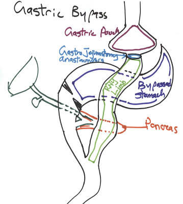 Gastro-gastric fistula after gastric bypass operation - DSSurgery