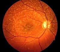 See Through My Eyes - Stargardt's Disease: Vitamin A and Stargardt's ...