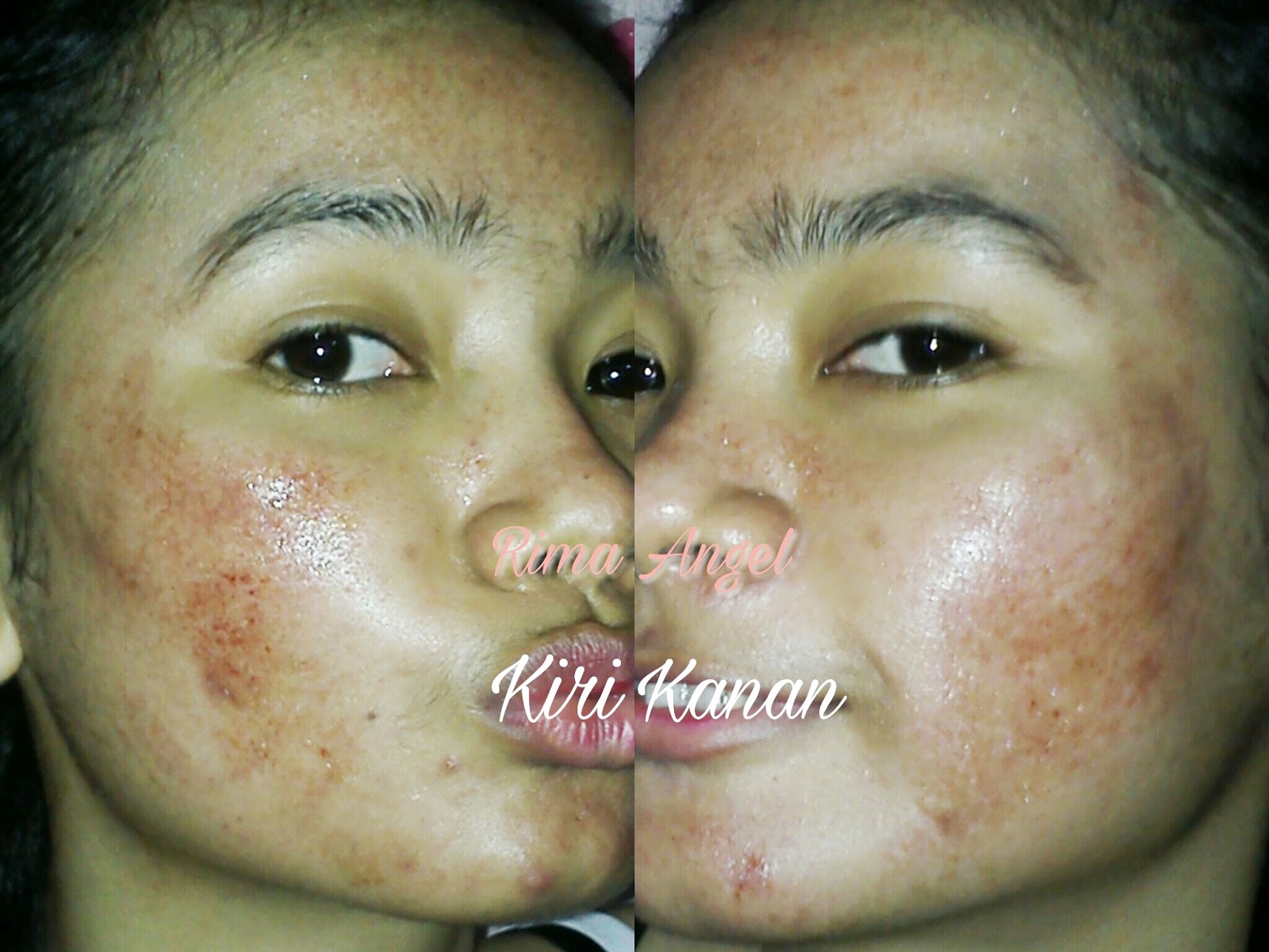 Pengalaman melakukan MTS (Micro Needle Theraphy System)