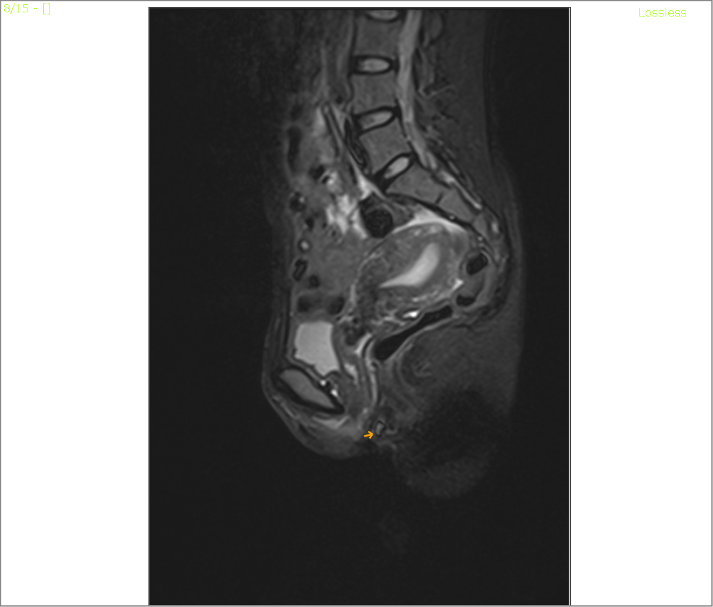 mricases: Episiotomy scar endometriosis