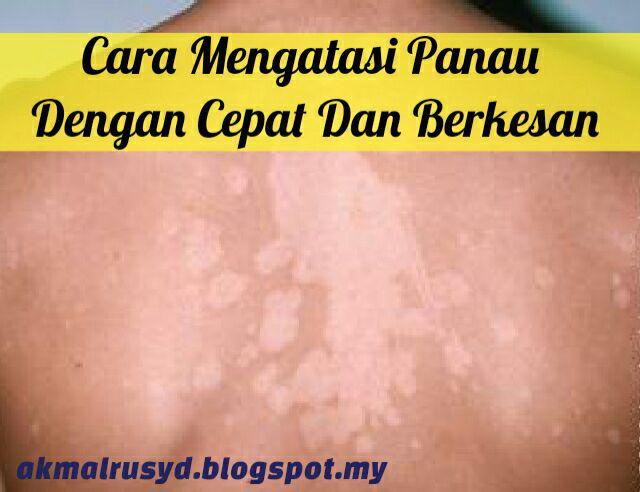 Cara Atasi Panau Dengan Cepat Dan Berkesan Elak Kembali Berulang