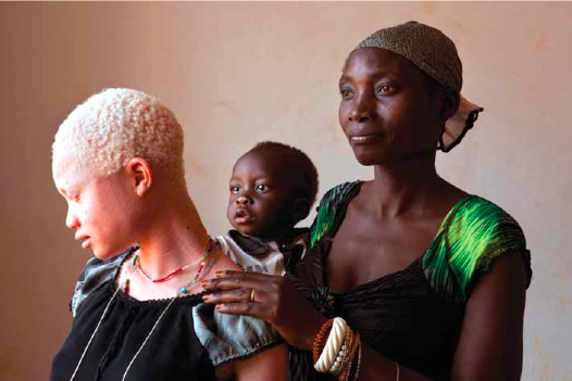 Angola Rising: Esteeming the Albinos in Angola