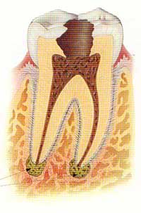 Necrosis Pulpar. Síntomas y tratamiento