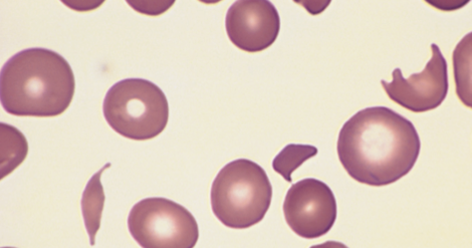 Microangiopathic Hemolytic Anemia Symptoms, Causes, Treatment - Health ...