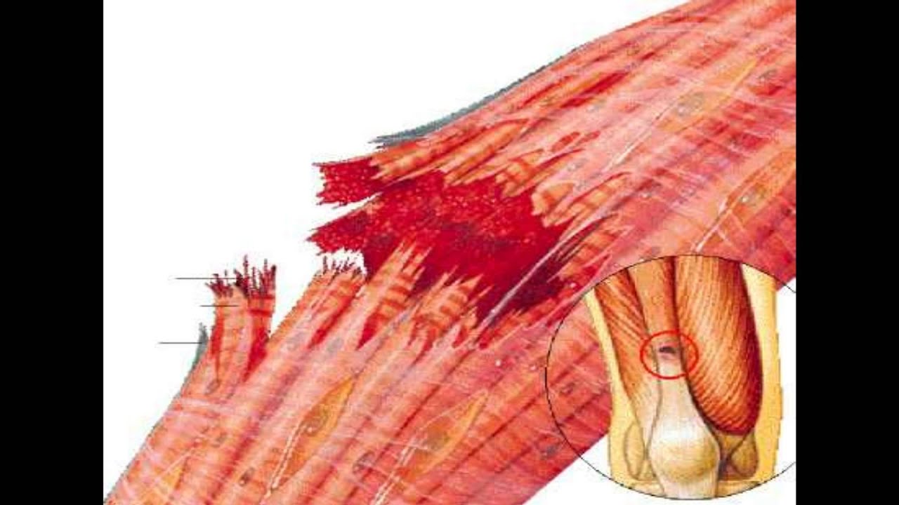TIPOS DE FIBRAS MUSCULARES Y SU INCIDENCIA EN EL DEPORTE: LESIONES ...