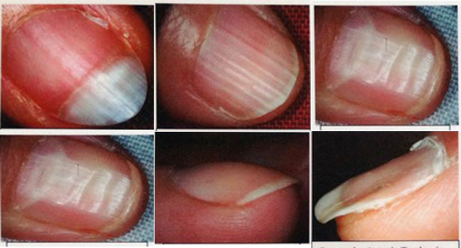 This is How To Identify Your Disease Using Your Nails!