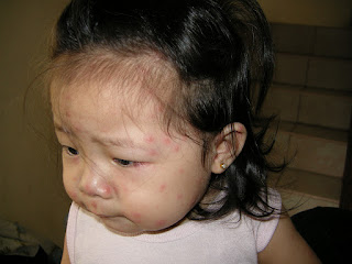 bulutong - philippin news collections