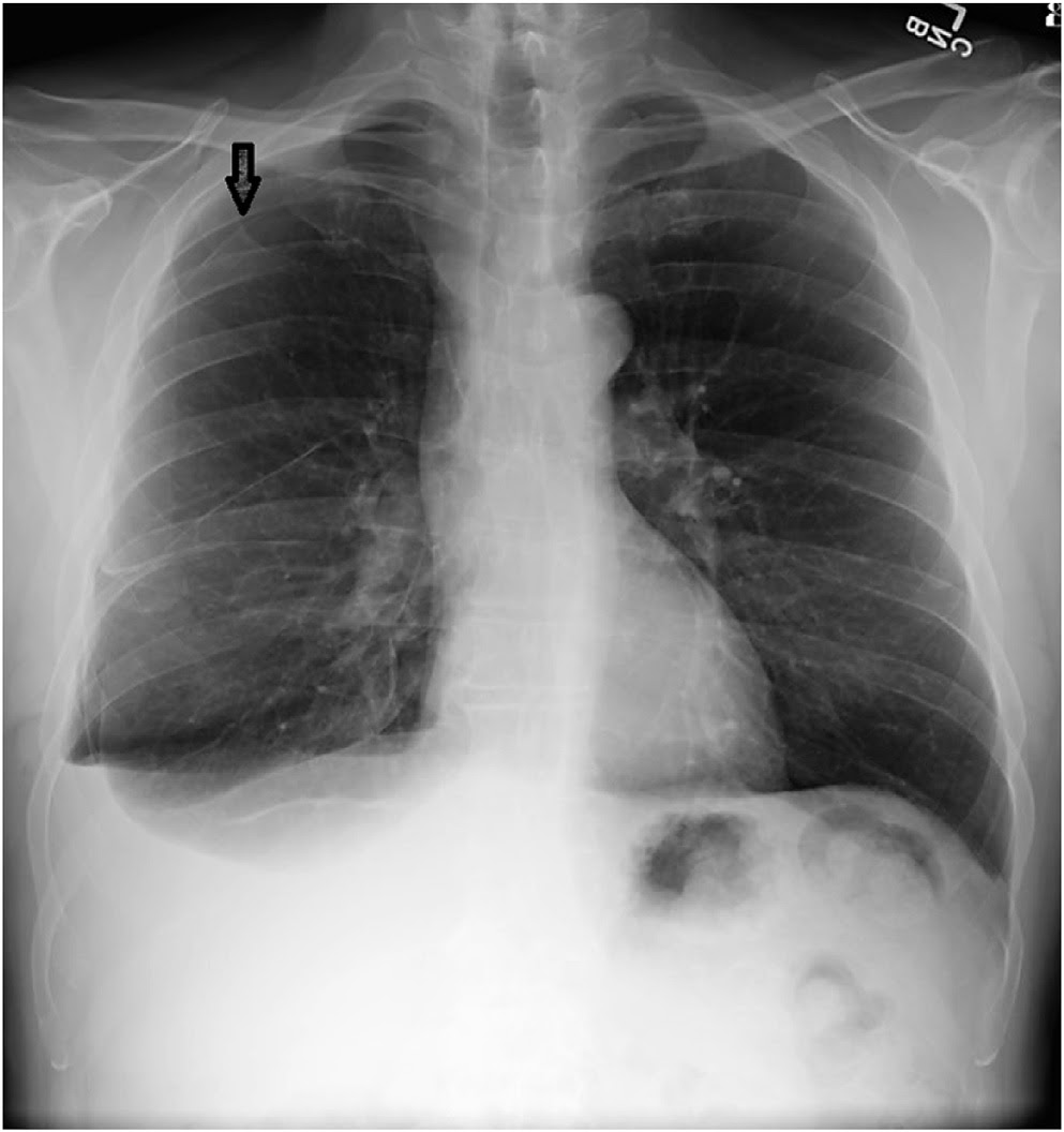 Fig. 3. Chest X-ray during last hospital visit demonstrating a ...