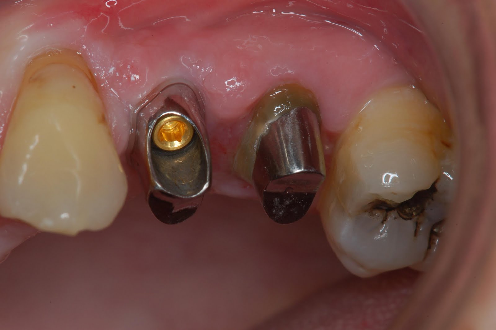 Docteur J.M. STROUMZA: PROFIL D’EMERGENCE : CLEF DE PERENITE IMPLANTAIRE