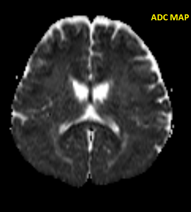 Leukodystrophy Teaching Points-MRI - Sumer's Radiology Blog