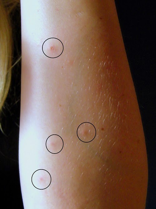 Tratamiento para las picaduras de pulgas - Vida Lúcida