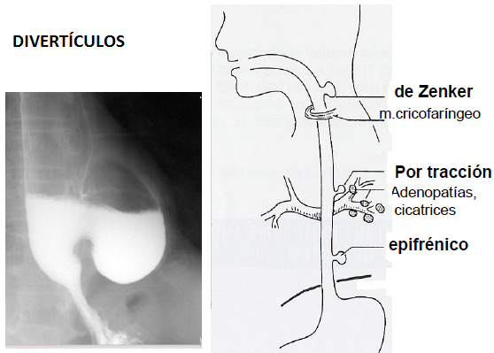 Patología : ESÓFAGO