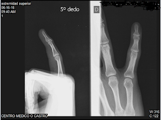 Traumatólogo de Guardia - Pedro Larrauri - Vigo.: Fractura articular en ...