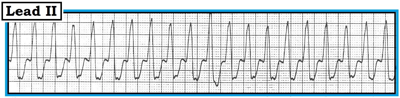 ECG Interpretation: ECG Interpretation Review #36: (WCT - VT - A Fib ...