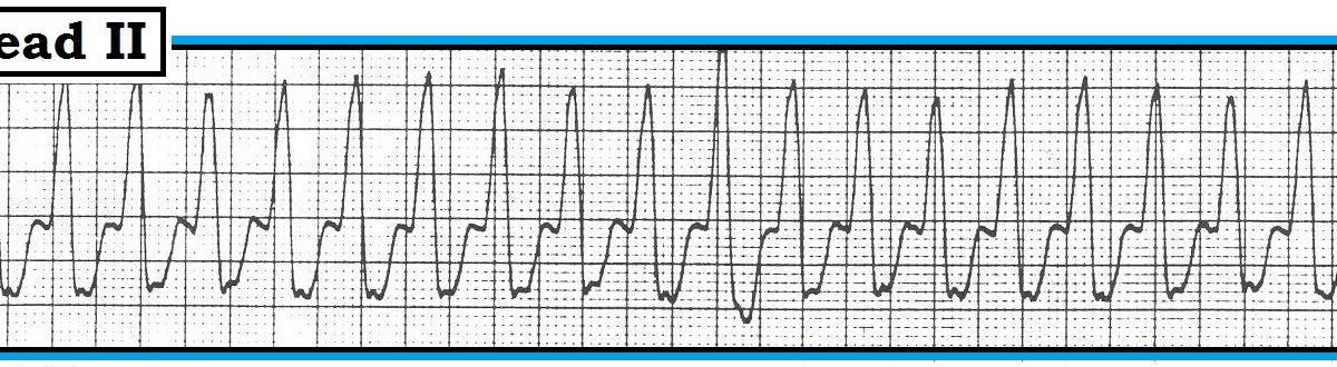 Wct Heart Rhythm
