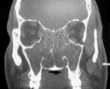 How to Read a CT Sinus Scan for the Layperson | Fauquier ENT Blog