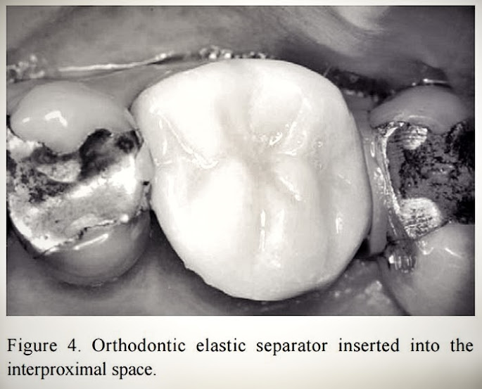 PDF: Interproximal space recovery using an orthodontic elastic ...