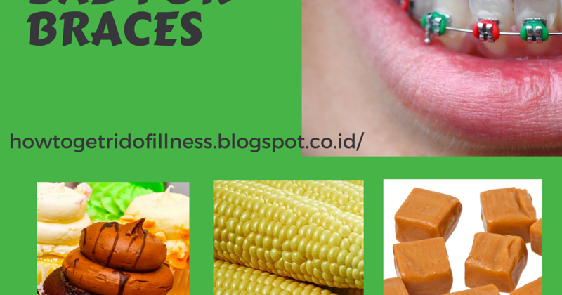 Do You Really Need Braces for Teeth? | How to Get Rid of Illness