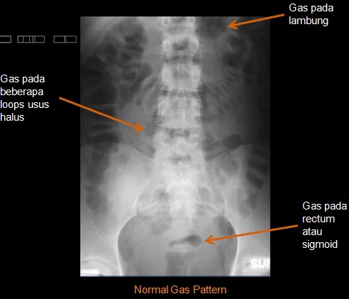 Dr Herry Setya Yudha Utama SpB. FInaCS. MHKes. ICS: Digestive surgery ...