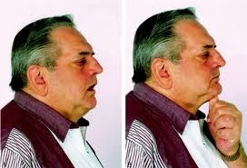 Medical Treatment Pictures-for Better Understanding: Kennedy Disease