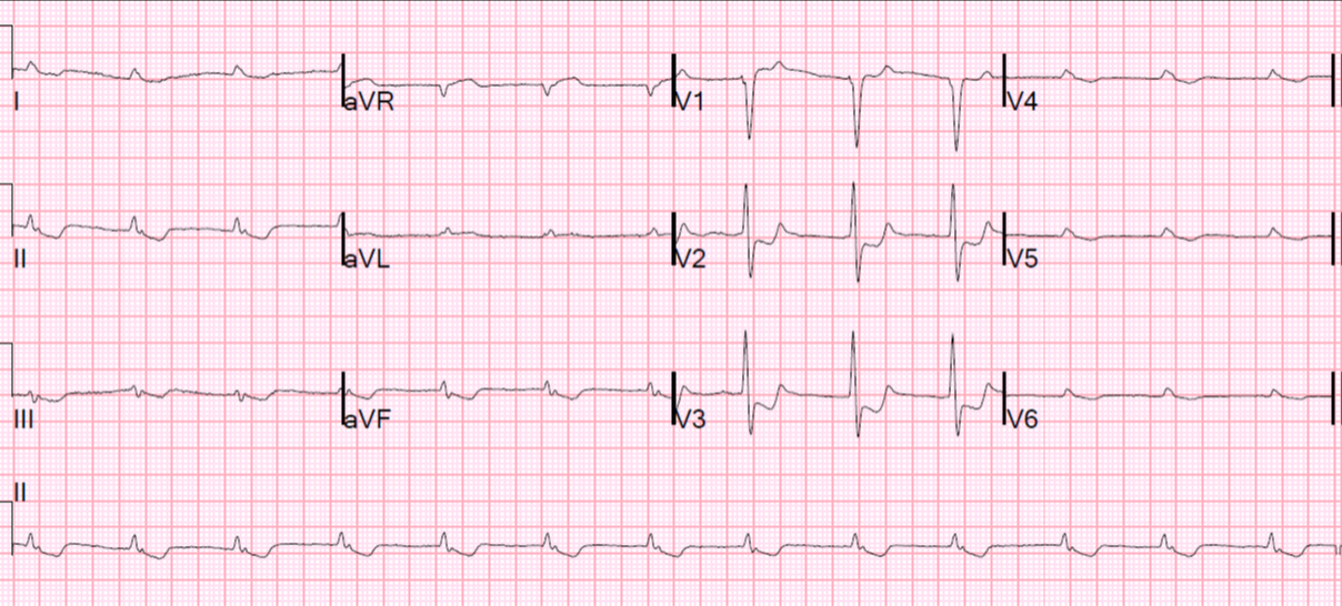 Dr. Smith's ECG Blog: Looks like a Posterior STEMI. Is it?