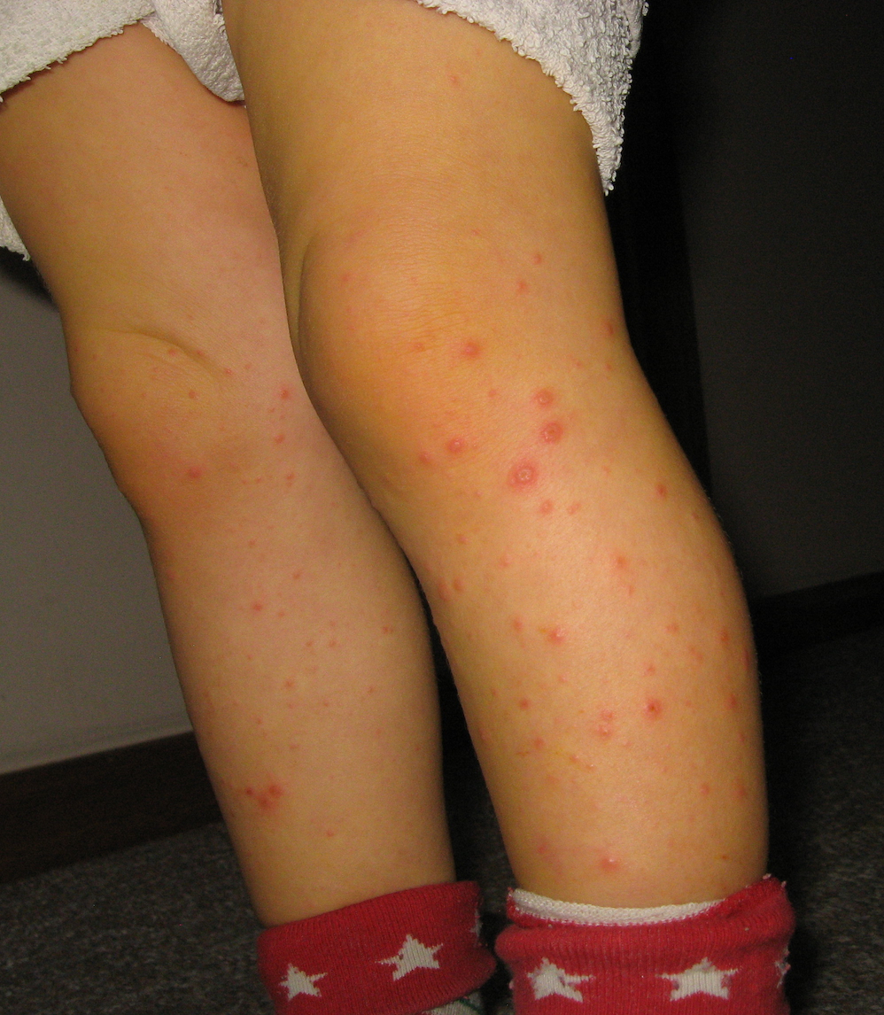 Albums 92+ Pictures What Are Scabies Images Updated