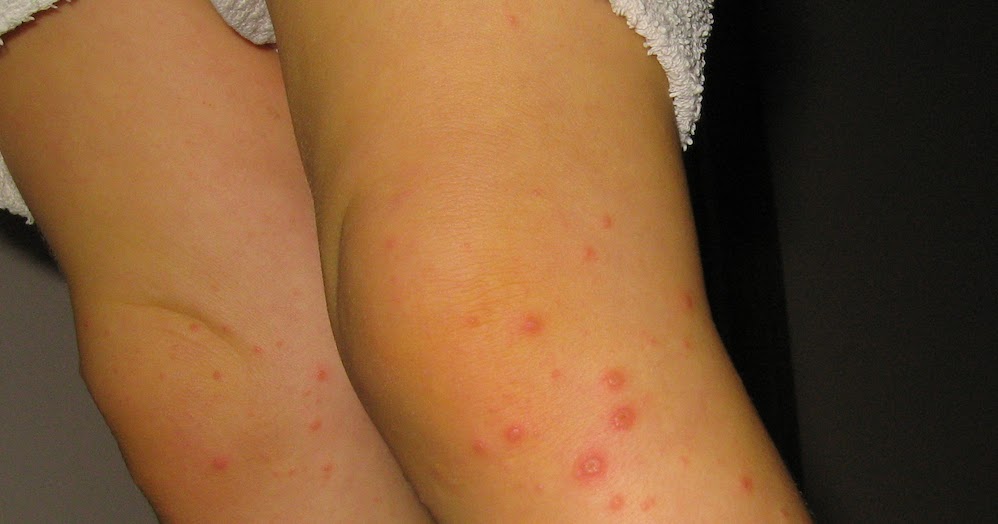 Why your Baby has Craw Craw: Causes, Treatment and Prevention Measures ...