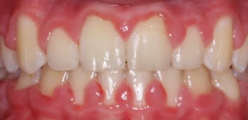 Abcès des Gencives • SoinDentaire