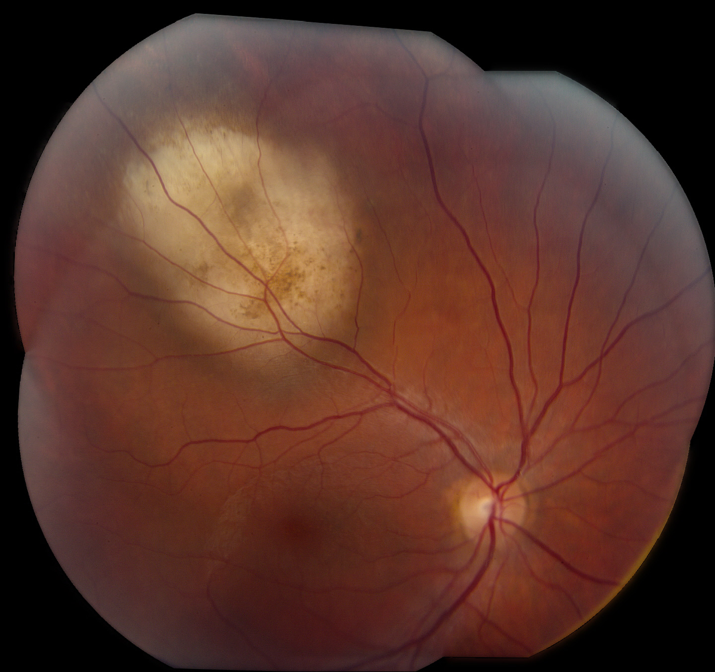 Whitman Images: Amelanotic Choroidal Lesion