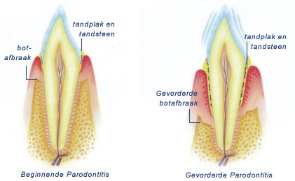 Blogs van Tandartspraktijk Top Dental: Bloedend tandvlees, hoe komt dat?