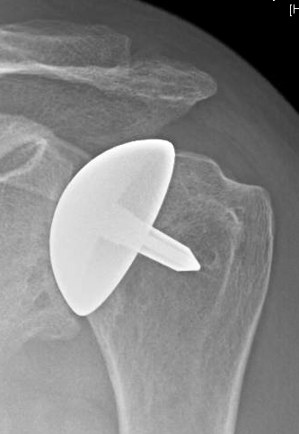 Shoulder Arthritis/Joint Replacement Rotator cuff tears: Humeral ...