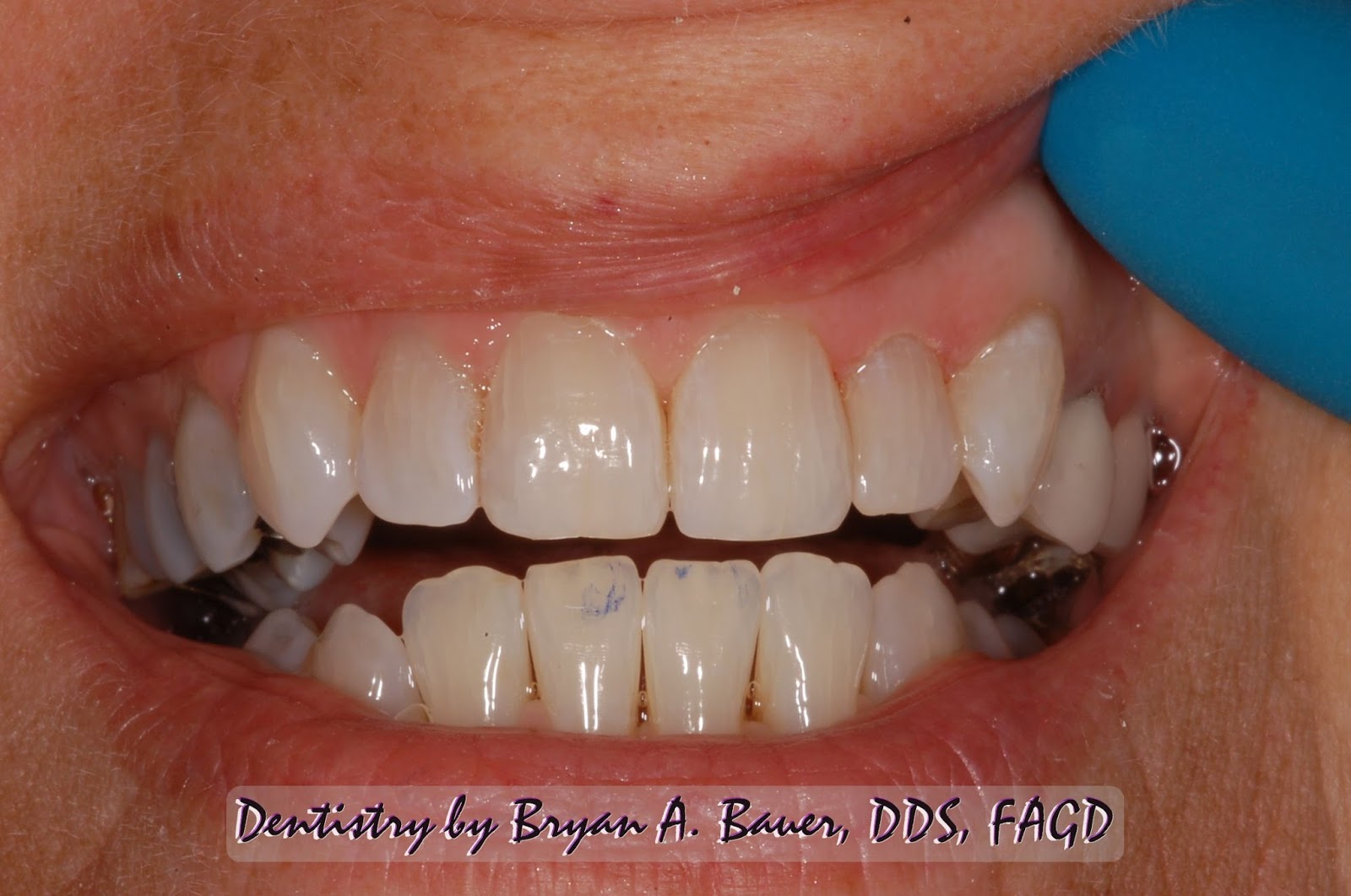 Old brown filling - Bauer Smiles