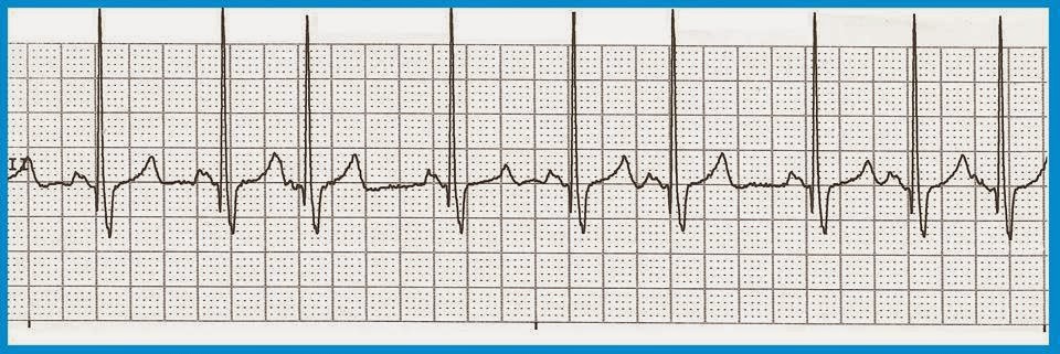 Various Rhythms with PACs