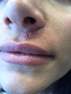 VIRTUAL GRAND ROUNDS IN DERMATOLOGY 2.0: Agminated Molluscum Contagiosum