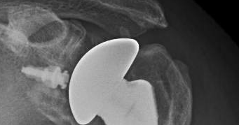 UW Shoulder and Elbow Academy: Get Shorty? Are short stemmed humeral ...