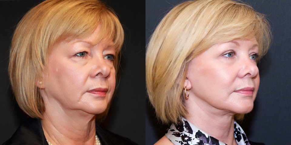 Plastic Surgery Of Short Hills: 5 of the Most Popular Facelift ...