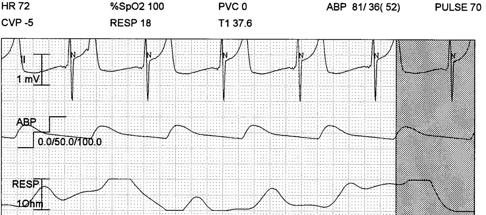 Pedi cardiology: Quiz, EKG: What is the rhythm? Junctional vs. Low ...