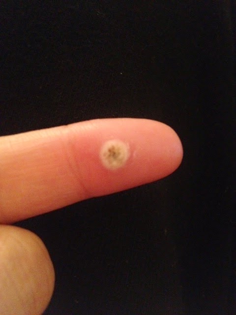 Photos of Warts on Hands and Fingers ~ How To Remove Moles, Warts, Skin ...