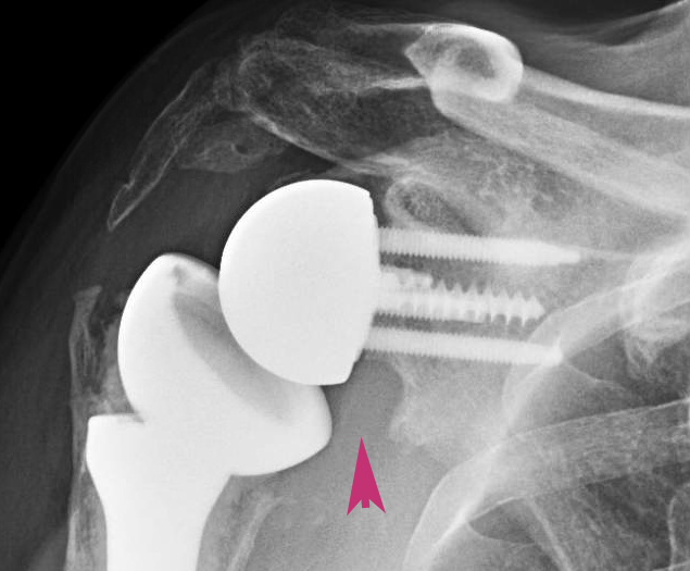 UW Shoulder and Elbow Academy: Scapular notching: is it about the notch ...