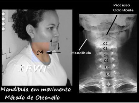 Cervical- Metodo de Ottonello