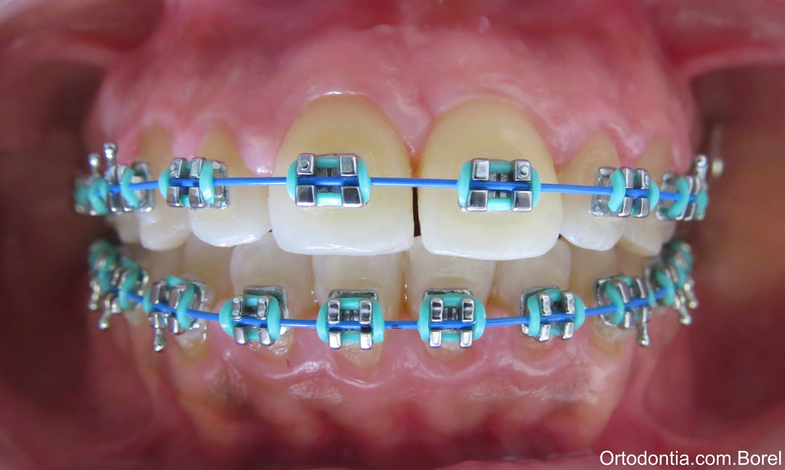 Aparelho Transparente Com Borrachinha Colorida - RETOEDU