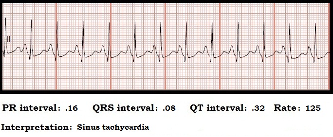 ECG Rhythm Strip Quiz 89: Interval measurements